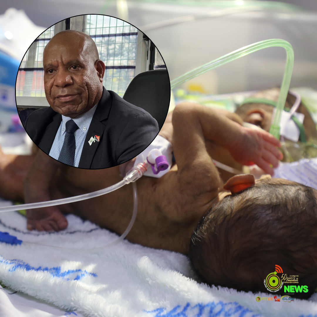 POMGEN YET TO ISSUE REFERRAL FOR CONJOINED TWINS - Kalang Advertising ...